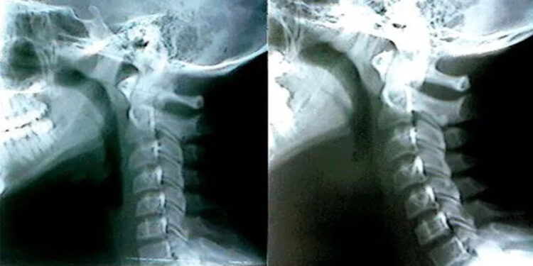 Cervical Lordosis Straightening: What Is It, Why Does It Happen, and ...