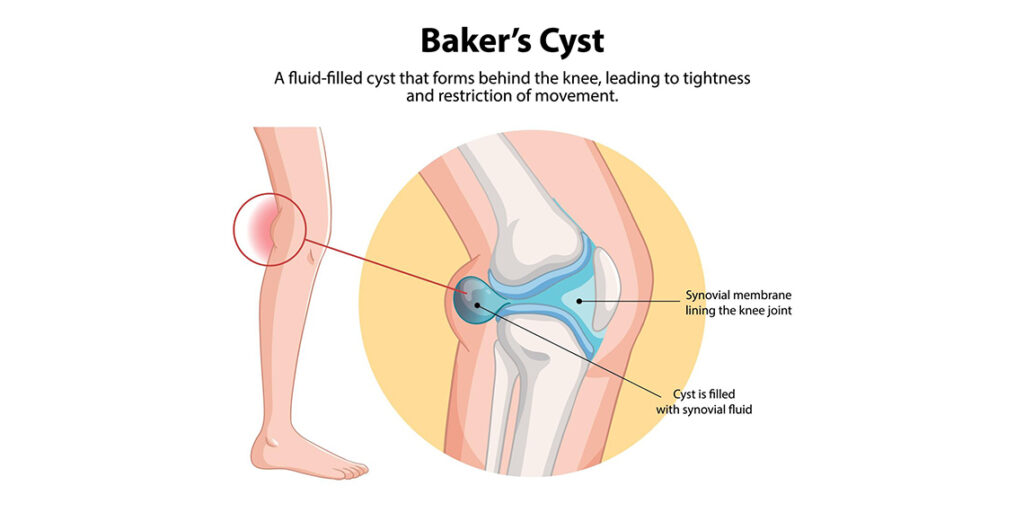 Baker's Cyst and Atlas Therapy / Manual Therapy Approaches - Atlas Terapi