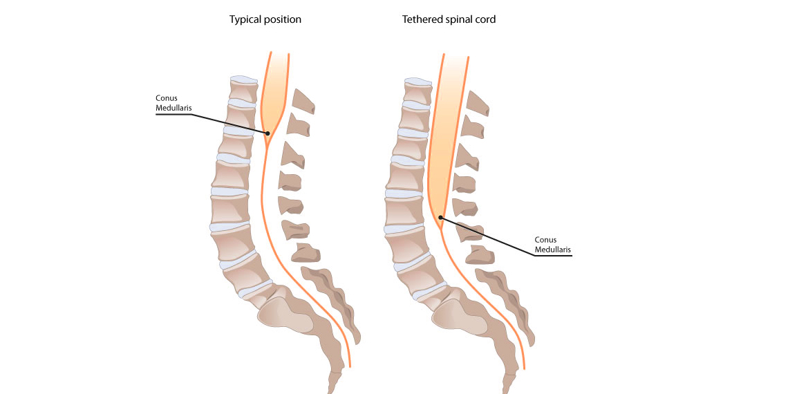 What is Tethered Cord Syndrome? - Atlas Terapi