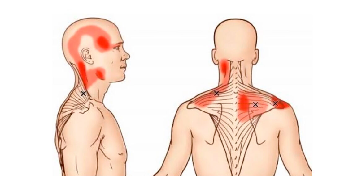 Trapezius Pain: Causes, Treatment Approaches, and Prevention Methods ...