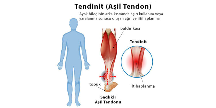 Tendinit: Mekanizması, Manuel Terapi ve Atlas Terapi ile İlişkisi ...